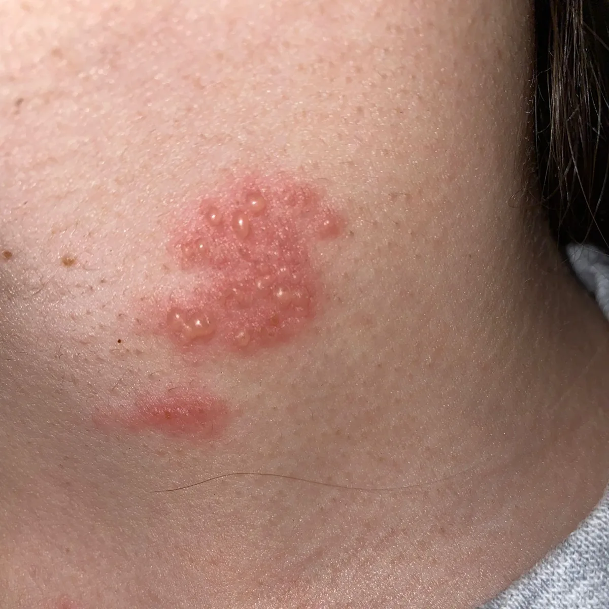 Shingles Herpes Zoster Dermatologist In Lake Worth Fl