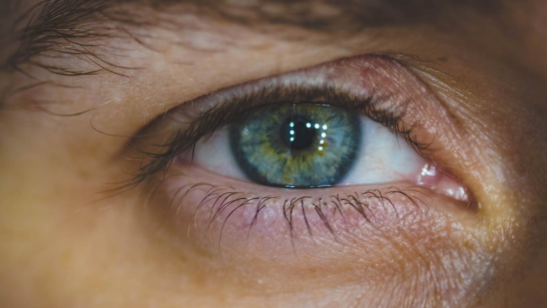 El orzuelo, una infección dolorosa y molesta producida por estafilococo ...