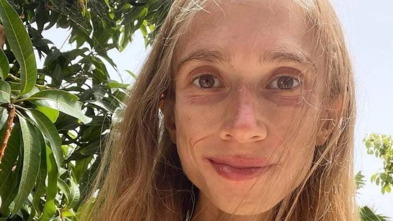 Quién era Karolina Krzyzak, la influencer que ha muerto en Bali: pesaba 22 kilos y solo comía ...